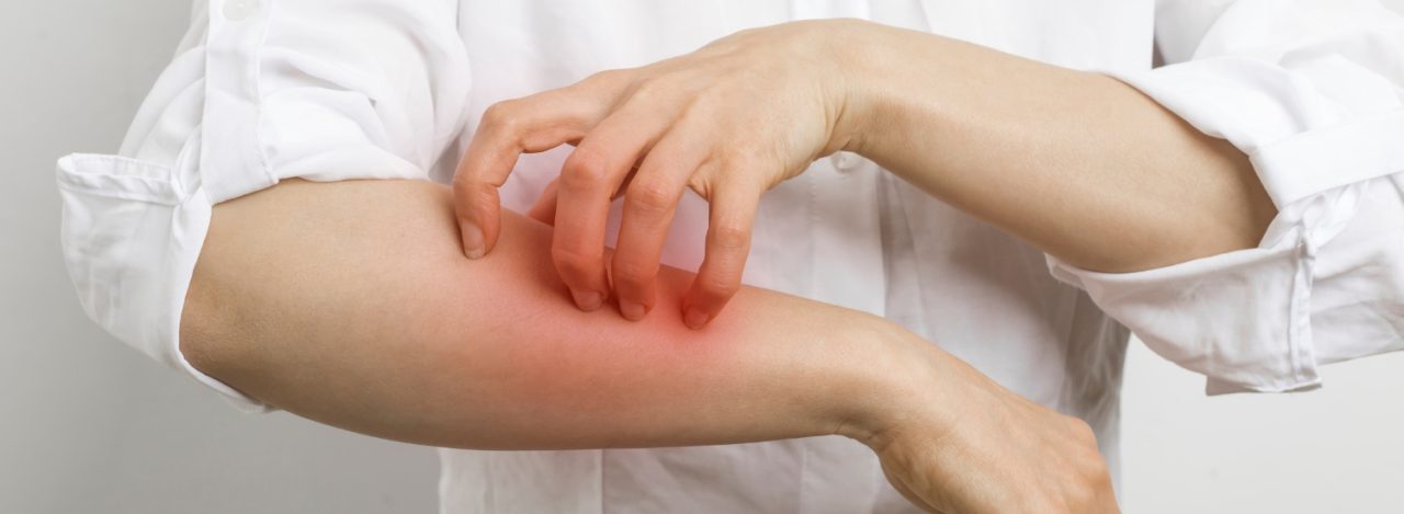 Allergic Skin Reactions: Cause Identification